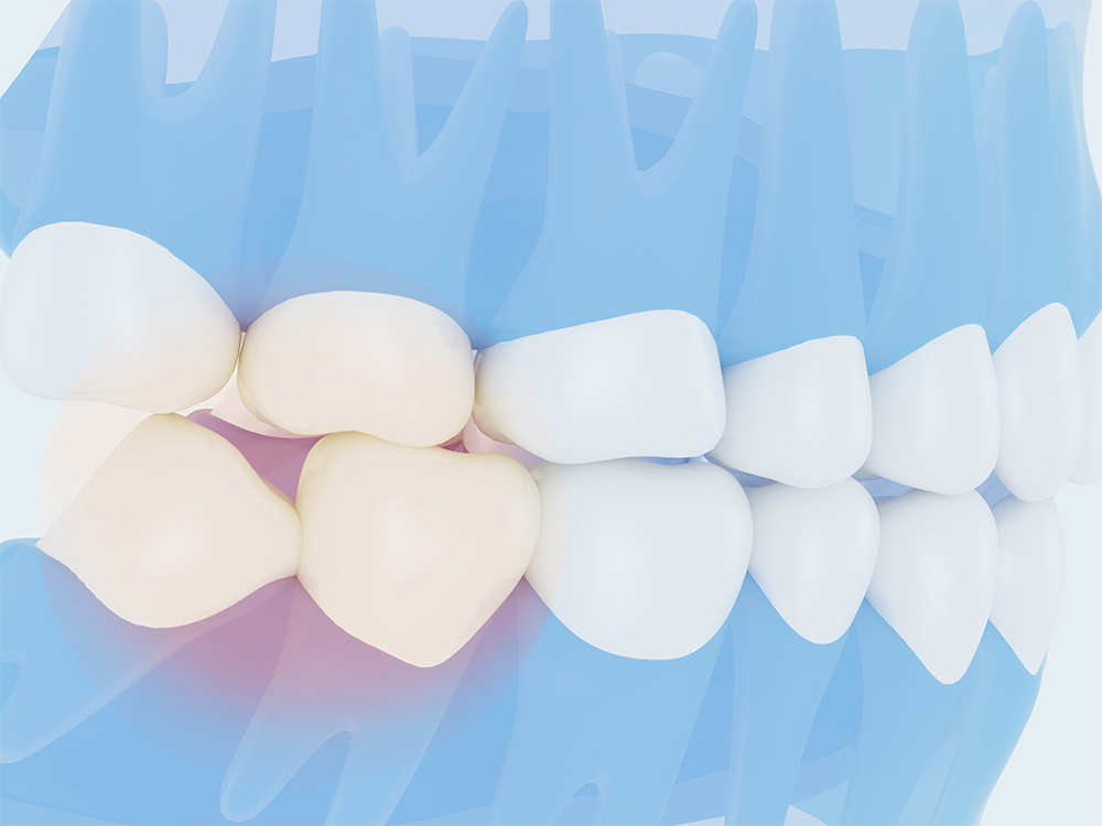 Wisdom Teeth: Everything You Need to Know - Pacific Family Dental